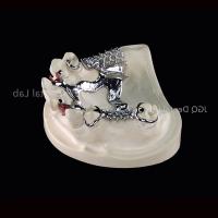 China 3D Printing Co Cr Alloy Removable Denture Framework Customized for Oral Restoration for sale