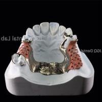 China Precise Fit Removable Dentures Metal Framework Customized for sale