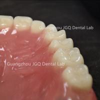 China Custom Acrylic Removable Dentures Natural Looking From China Dental Lab for sale