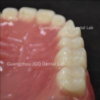 China Custom Acrylic Removable Dentures Natural Looking From China Dental Lab for sale