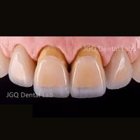 China High Translucency Cast Porcelain Emax Veneers China Dental Lab OEM for sale