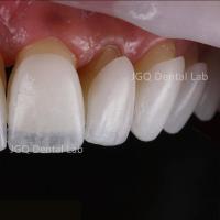 China High Translucency Cast Porcelain Emax Veneers China Dental Lab OEM for sale