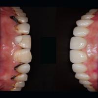 China E.max All Ceramic Dental High Translucency China Dental Lab for sale