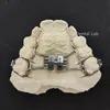 China 3D Printing Minimal Prep Orthodontic Arch Expander For Teenager for sale