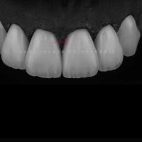 China Tooth Like Shells Dental Porcelain Emax Veneers Dsd Design China Dental Lab for sale