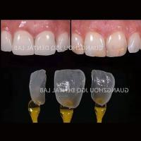 China Tooth Like Shells Dental Porcelain Emax Veneers Dsd Design China Dental Lab for sale