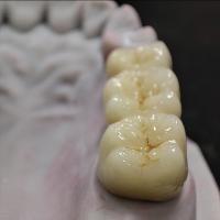 China Natural Aesthetics Zirconia Crown with 1200 MPa Flexural Strength and Customized Design for Dental Restorations for sale