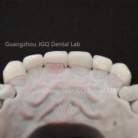 China Customized Dental Laminate Veneers and Zirconia Crown with Fast Turnaround and Biocompatible Materials for sale