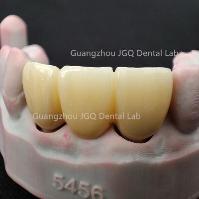 China Professional Guangzhou Dental Manufacturer Premium Zirconia Solutions High Aesthetic  Anterior Smile Design for sale