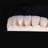 China Custom Layered Zirconia Perfect Shade Matching for Front Teeth Cosmetics for sale