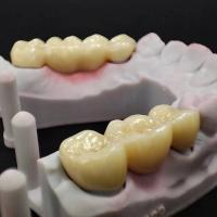 China Medical Grade Zirconia Crowns Full Contour Stained Polished for Broken Teeth for sale