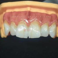 China Custom Layered Zirconia Perfect Shade Matching for Front Teeth Cosmetics for sale