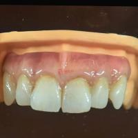 China Dental Lab China High Esthetics Full Contour Crown Dental Zirconia Bridge for sale