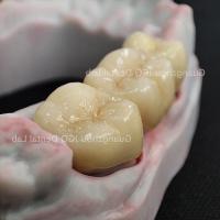 China Natural Translucent Zirconia Seamless Integration with Natural Dentition Experienced Dental Manufacturer Good Price for sale