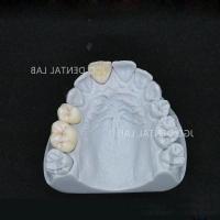 China 3Shape CAD CAM Bulk Zirconia Precision Marginal Fit China Leading Lab for sale