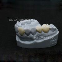 China High Strength Monolithic Zirconia Stable Restoration Competitive Prices China Dental Lab for sale
