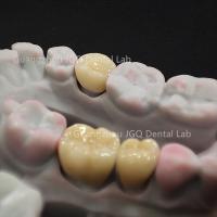 China 3Shape CAD CAM Bulk Zirconia Precision Marginal Fit China Leading Lab for sale