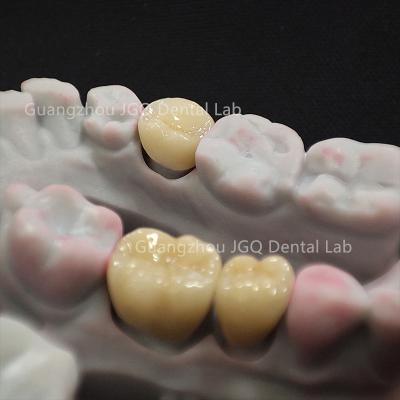 China 3Shape CAD CAM Bulk Zirconia Precision Marginal Fit China Leading Lab for sale
