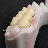 China Medical Grade Zirconia Restorations International Certification Standards for Permanent Clinical Use for sale