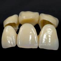 China Customized High-Quality Zirconia Dentures Crafted with Precision for Superior Durability and Aesthetic Appeal From Jgq Dental Lab for sale