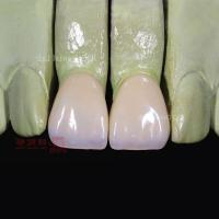 China Natural Translucent Zirconia Restorations Custom Designed For Anterior Teeth for sale