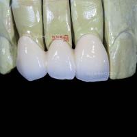 China Natural Translucent Zirconia Restorations Custom Designed For Anterior Teeth for sale