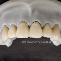 China Natural Translucent Zirconia Restorations Custom Designed For Anterior Teeth for sale