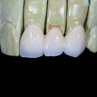 China Bulk Zirconia Restorations China Dental Lab Outsourcing Partner for sale