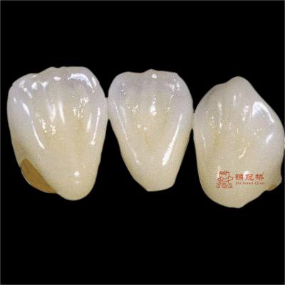 China Cobalt Chrome Alloy Porcelain Fused To Metal Crown Pfm Tooth Crowns for sale
