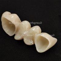 China High Toughness Zirconia For Heavy Occlusion And Bruxism Protection for sale