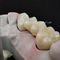 China 3Shape Digital Workflow Zirconia Precise Occlusal Alignment Technology JGQ Dental Lab Custom Zirconia Restoration for sale