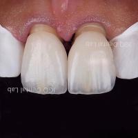 China Medical Grade Dental Zirconia Restoration Precision CNC Milling Customized for sale