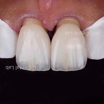 China CNC Precision Milled Zirconia Crowns Bridges Layered / Monolithic Zirconia Restoration for sale