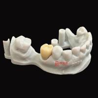 China Custom China Dental Lab Zirconia Crown Bridge for All Oral Conditions for sale