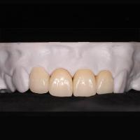China Zirconia Dentures Teeth Dental Lab Single Crown Anterior Posterior Dental Restoration for sale