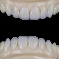 China Medical Grade Zirconia Crown Bridge Precision Crafted By Professional Dental Lab for sale