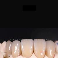 China Medical Grade Zirconia Crown Bridge Precision Crafted By Professional Dental Lab for sale