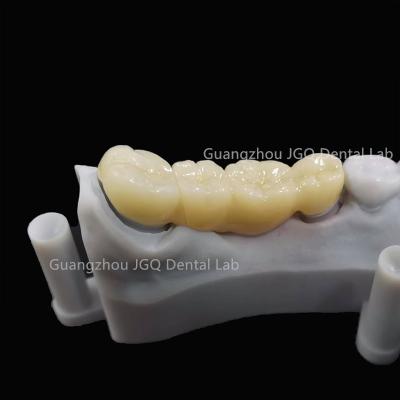 China Custom Dental Lab Zirconia Crown Bridge Full Anatomical Design High Accuracy for sale
