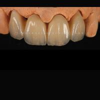 China CNC Precision Milled Zirconia Crowns Bridges Layered / Monolithic Zirconia Restoration for sale