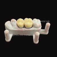 China Solid Zirconia Solution for Severe Occlusal Pressure Molar Rehabilitation Aesthetic Layered Zirconia Natural Translucency for sale