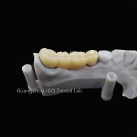 China Custom China Dental Laboratory Zirconia Crown Bridge for Global Clinics for sale