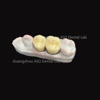 China Custom China Dental Laboratory Zirconia Crown Bridge for Global Clinics for sale