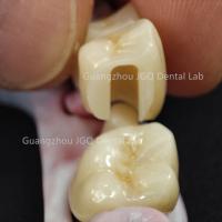China Dual Zirconia Crown Bridge Precision Crafted By China Dental Lab for sale