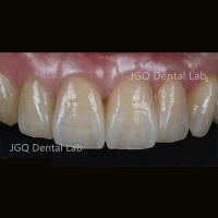 China CNC Milled Esthetic Zirconia Crown Bridge High Precision Fast Shipping for sale
