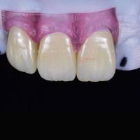 China CNC Milled Esthetic Zirconia Crown Bridge High Precision Fast Shipping for sale