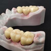 China Ultra Strong Zirconia Crown Bridge Stable Structure For Posterior Restoration for sale