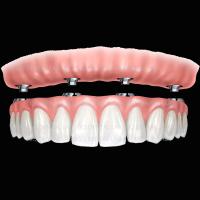 China Full Mouth Dental Implant Bridge Customized Implanting Guide For Oral Restoration for sale