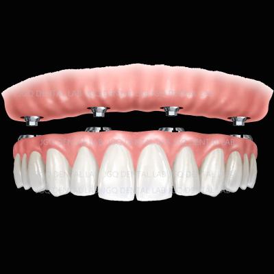 China Full Mouth Dental Implant Bridge Customized Implanting Guide For Oral Restoration for sale