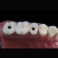 China Custom China Dental Lab Milling Service Titanium Zirconia Dental Implants Abutment for sale