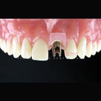 China Custom China Dental Lab Milling Service Titanium Zirconia Dental Implants Abutment for sale